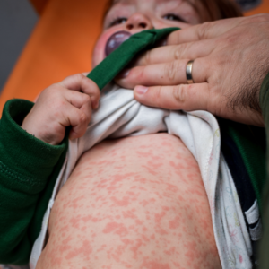 Measles Exposure at Disney on Ice Event - Anderson Hills Pediatrics